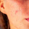 Easy home remedies to get rid of boils