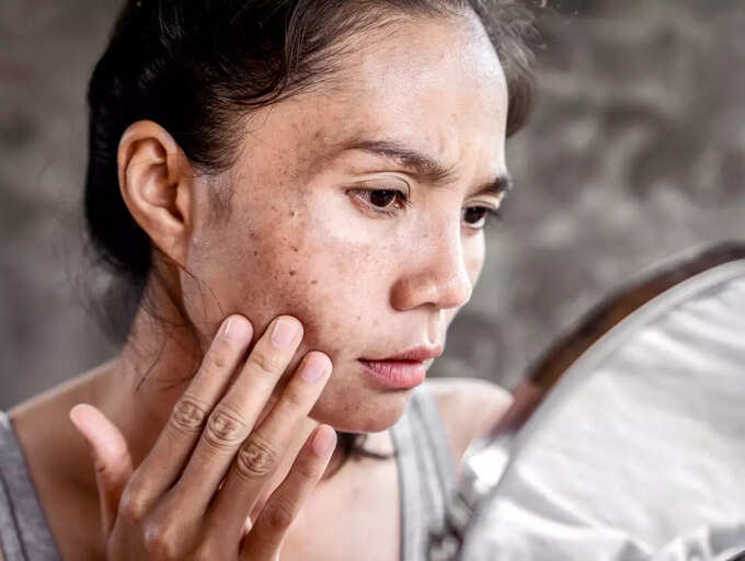 Eating these foods can reduce skin pigmentation | The Times of India