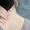 7 home remedies that can give relief from summer season itchiness