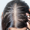 Is scalp inflammation secretly sabotaging your hair?