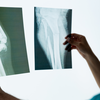 Think Osteoporosis is a women's disease? Here's why men should be ...