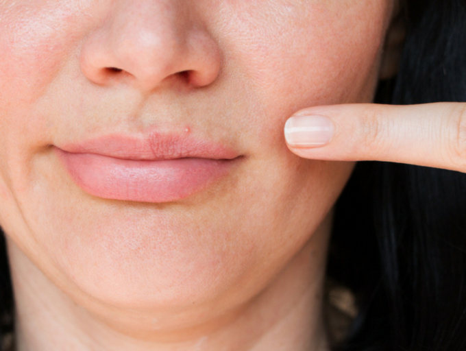 Home remedies: Your common skin issues resolved right here! | The Times ...