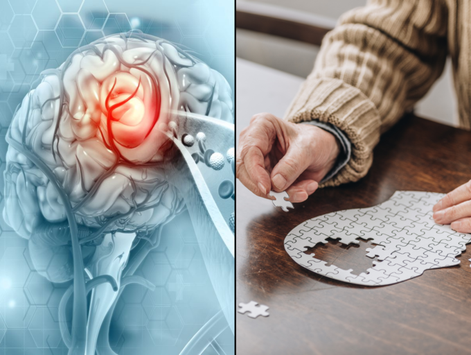 Brain Damage Symptoms: One-third of stroke survivors develop dementia ...