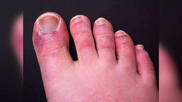 From hairy tongue to COVID toe: 5 unusual COVID symptoms