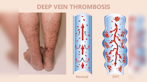 Deep vein thrombosis: 18-year-old thought she had pulled a muscle ...