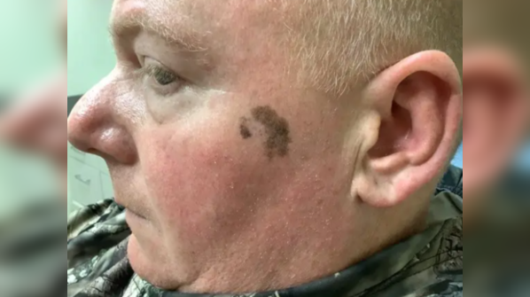 Skin cancer: Dermatologist approached a man on a train for the dark ...
