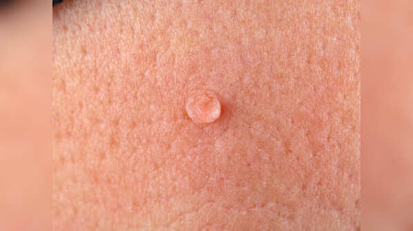 Warts Home Remedies: 5 Home Remedies to Get Rid of Warts | How to ...