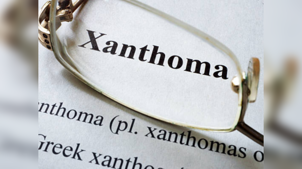 High Cholesterol Symptoms: Could it be high cholesterol? Signs on hands ...