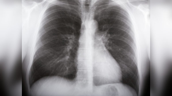 Signs your lungs haven’t fully recovered from COVID