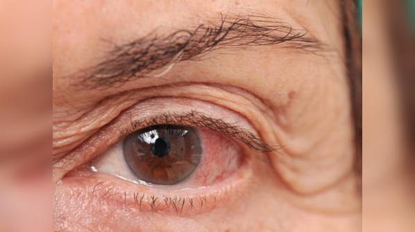 Cholesterol symptoms: 3 Warning signs of high cholesterol in your eyes