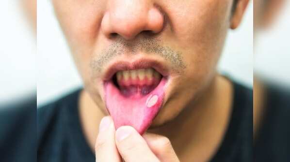Coronavirus oral symptoms: Apart from loss of taste, look out for these ...