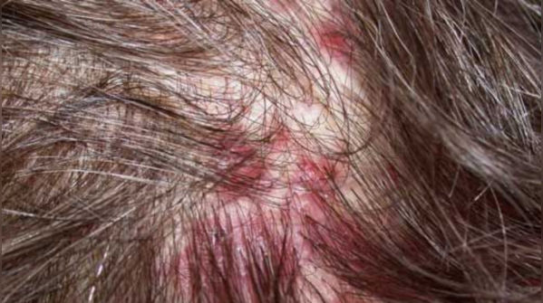 Is scalp inflammation secretly sabotaging your hair?
