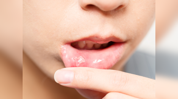 Mouth ulcer remedies for quick relief