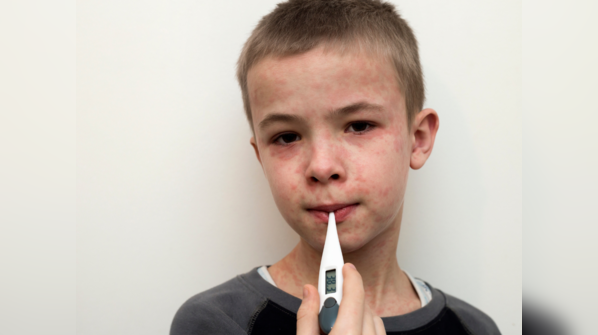 Chickenpox Symptoms: New variant of chickenpox-causing virus found in ...