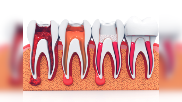 Tips to brush right after root canal treatment
