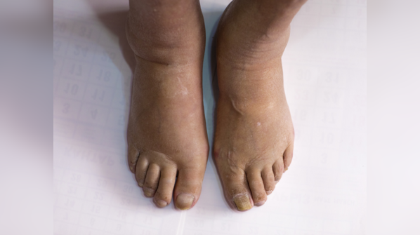 Diabetes Symptoms: 6 warning signs of diabetes in legs | The Times of India