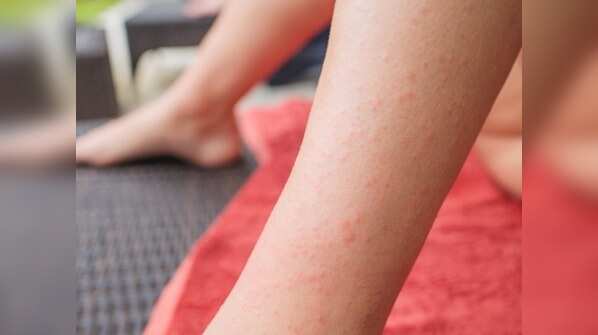 Coronavirus symptoms: Skin rash could a prominent symptom, suggests a study