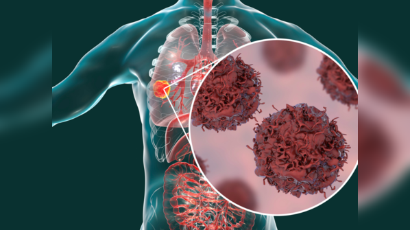 Here's how obesity increases the risk of 18 types of cancer