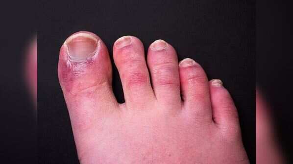 Covid Toes: What is COVID toes? Causes, symptoms and all you need to know