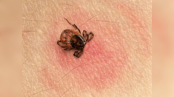 What is Lyme Disease: Lyme disease in Kerala, Everything you need to ...