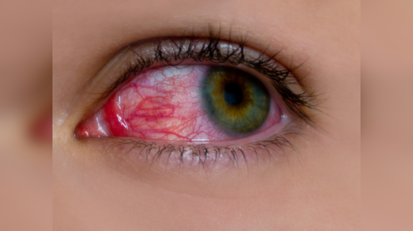 These signs of eye shingles should never be ignored