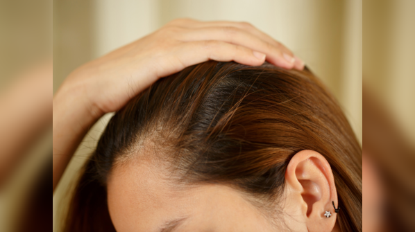 Different types of hair loss: How to recognize the signs and treat it