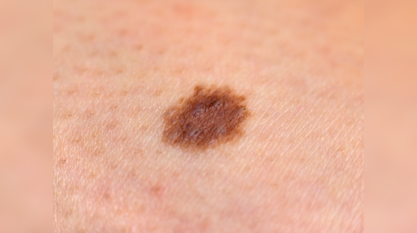 If you have moles on these parts of your body, here's what it means ...