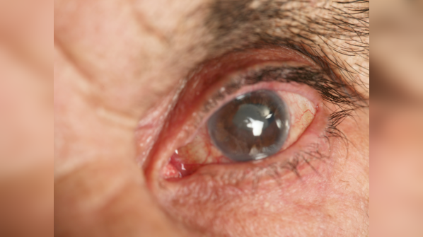 These signs of eye shingles should never be ignored