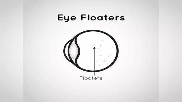 High cholesterol: Eye floaters in your vision could be a sign