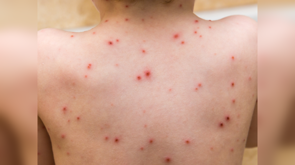 Chickenpox Symptoms: New variant of chickenpox-causing virus found in ...