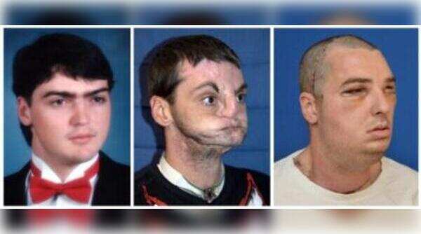 US man's face transplant