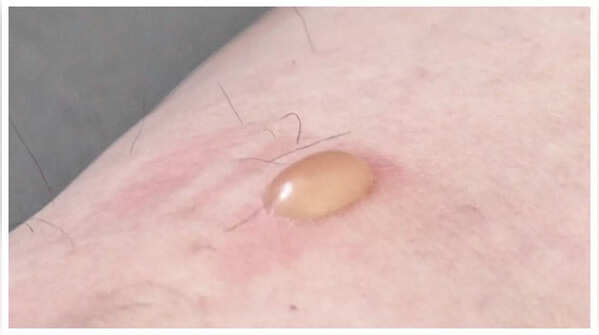 High Cholesterol: 6 symptoms of high cholesterol seen in body and face