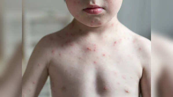 Monkeypox risk for kids: As more cases in kids are reported, here's ...