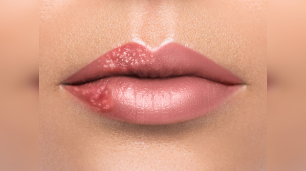 Infections you can catch through oral sex and how to prevent them