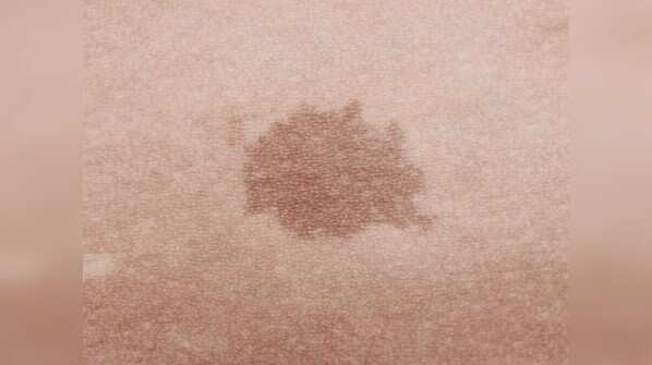 What the moles on your body reveal about your past life