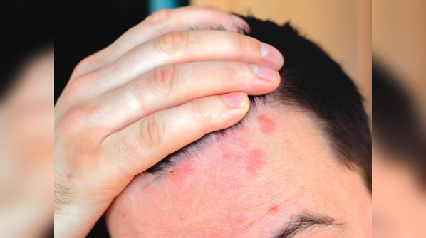 Signs of high cholesterol on face you should never ignore