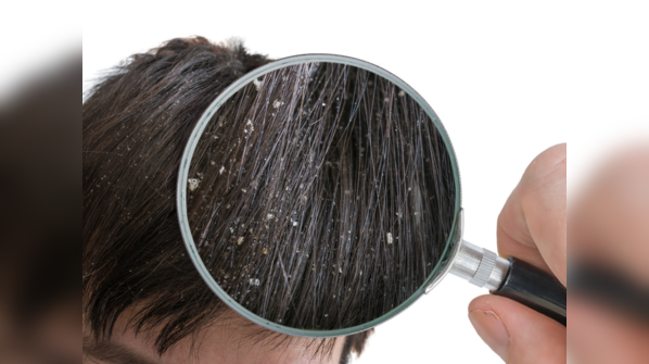 What causes dandruff? How to prevent it?