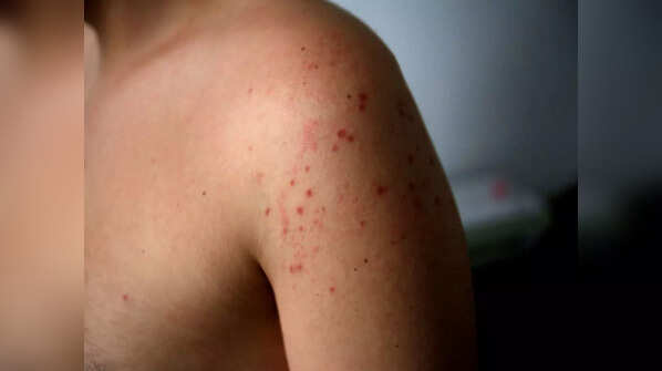 Coronavirus: Chickenpox-like rash and other less talked about troubling ...