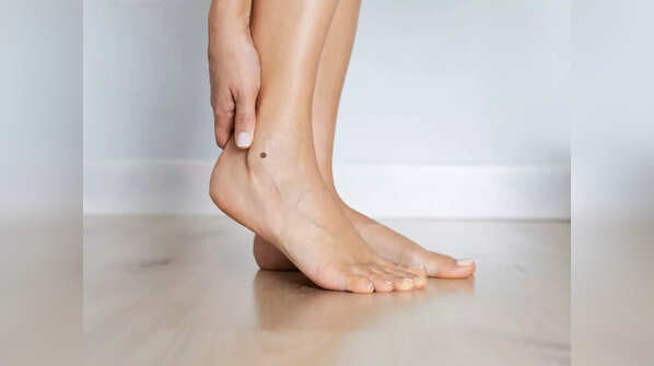 Moles on Body Parts: What moles on different body parts reveal about ...