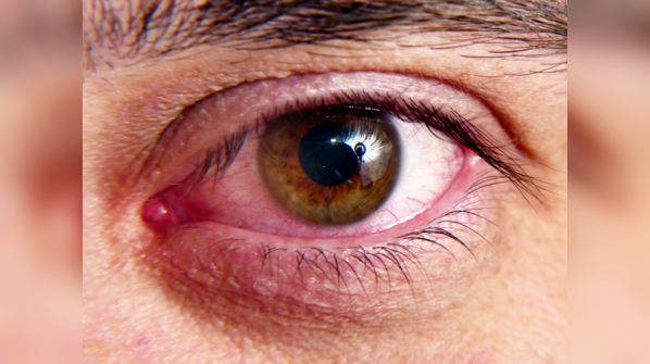 Eye Cancer Symptoms: Retinoblastoma: Easy to miss symptoms of eye ...