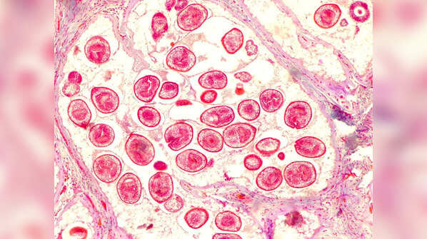 Breast lumps: How to tell if it's cancerous or benign