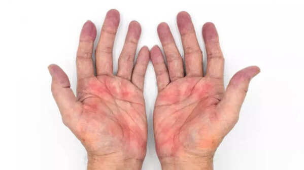 5 signs of liver disease seen on face and skin