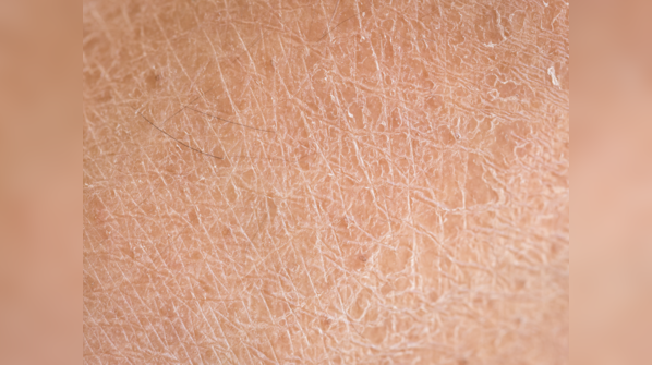 Vitamin deficiency: 5 tell-tale signs of Vitamin C, D and other ...