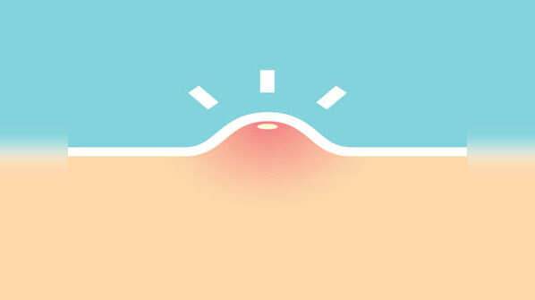 Got acne in pubic area? 5 remedies to treat it!