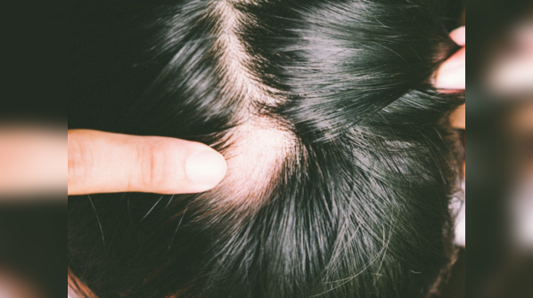 Hair Loss: 7 reasons that cause hair loss and how to stop it