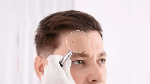 Revealed! What your birthmark conveys about your personality