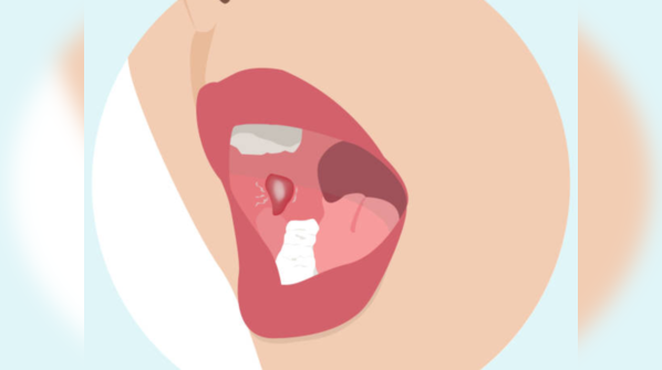 Oral cancer: Specific areas in your mouth where cancer can begin (along ...