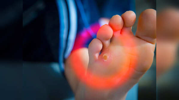 Diabetes symptoms in your feet: Seven signs that indicate high blood ...