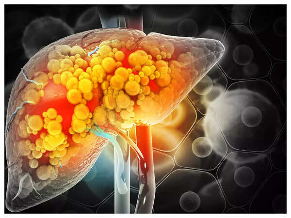 “But doctor, beer isn’t alcohol”? Why alcoholic fatty liver is tough to ...