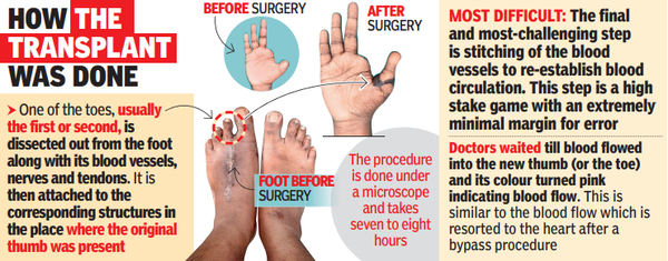 Thumb: Worker’s Toe Becomes Thumb At City Hospital | Chennai News ...